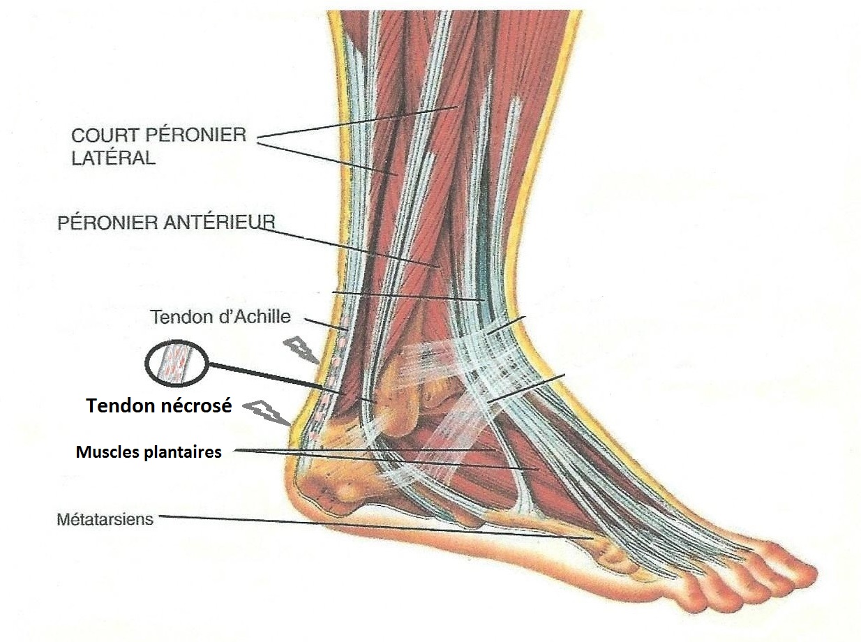 La tendinopathie d’Achille | HAC