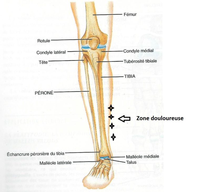 La périostite tibiale | HAC